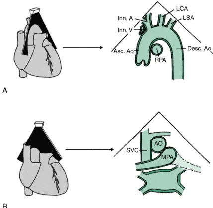 PULMONARY ATRESIA WITH INTACT VENTRICULAR SEPTUM