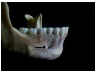 Posisi Foramen Mentalis Pada Mahasiswa Suku Batak Ditinjau Dari ...