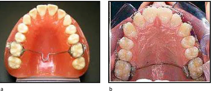 Hubungan besar retraksi anterior terhadap perubahan posisi molar ...