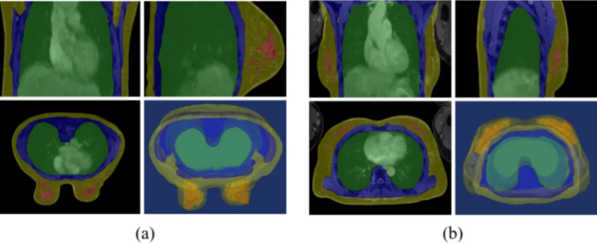 Supine-prone tissues in Breast MRI - A research on medical image ...